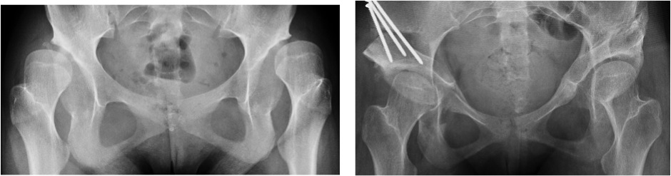 Treatment Options – Healthy Hip